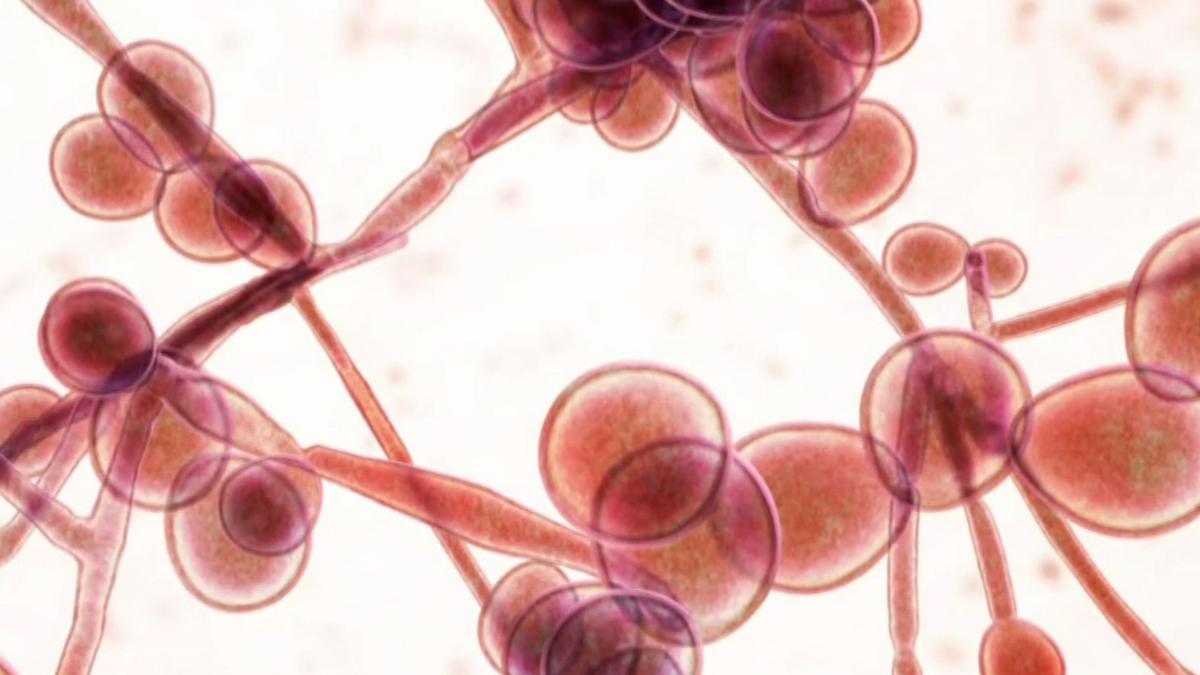 Watch CBS Evening News: Drug-resistant superbug fungus spreads in Texas ...