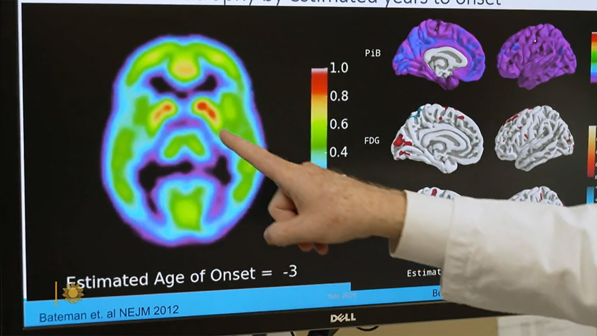 Watch Sunday Morning: Promising clinical trials for Alzheimer's - Full ...