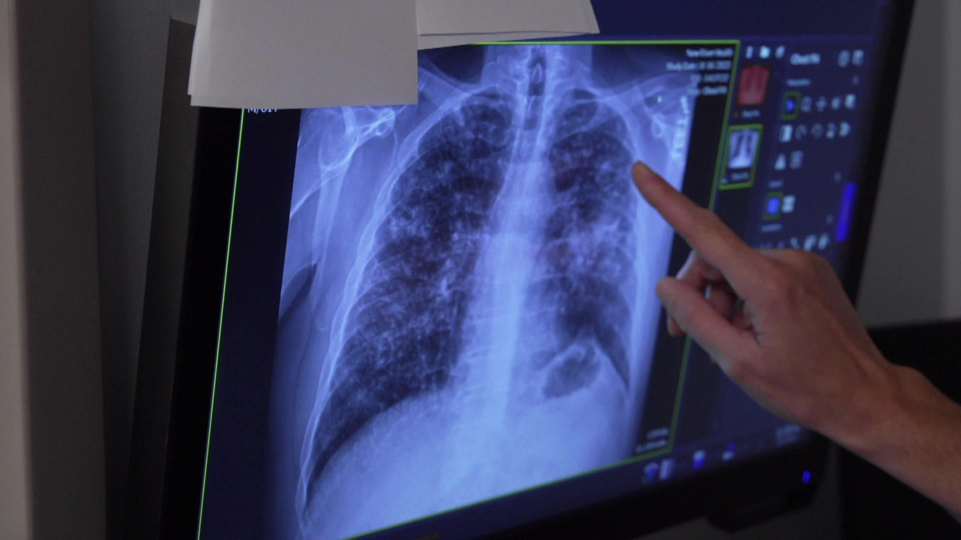 Watch Sunday Morning: Young coal miners suffering from black lung ...