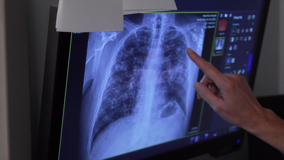 Watch Sunday Morning: Young coal miners suffering from black lung ...
